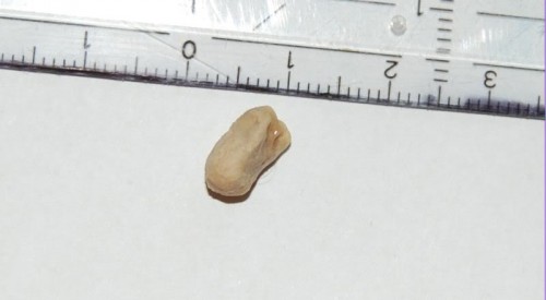 Blasengrieß und Blasensteine